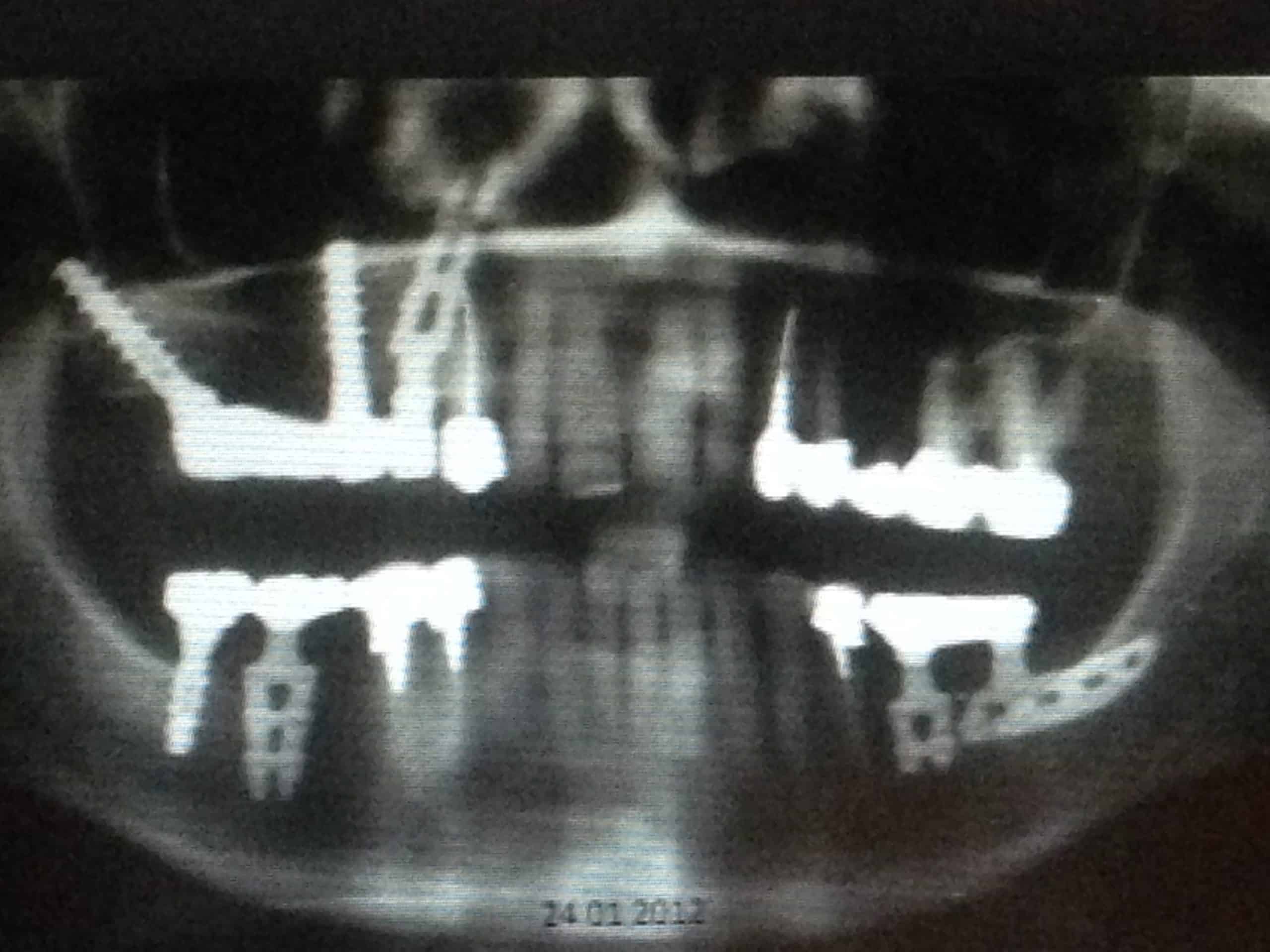 Ramus Blade - Advanced Dentistry & Dental Implant Center