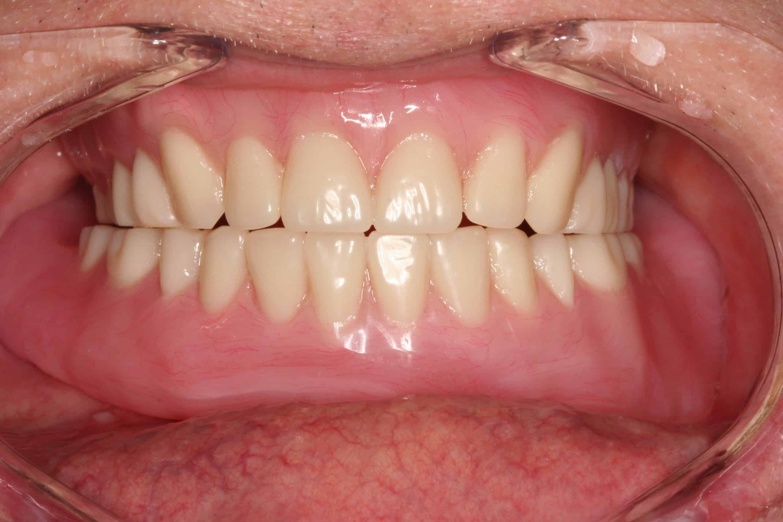 Implant Overdenture - Advanced Dentistry & Dental Implant Center