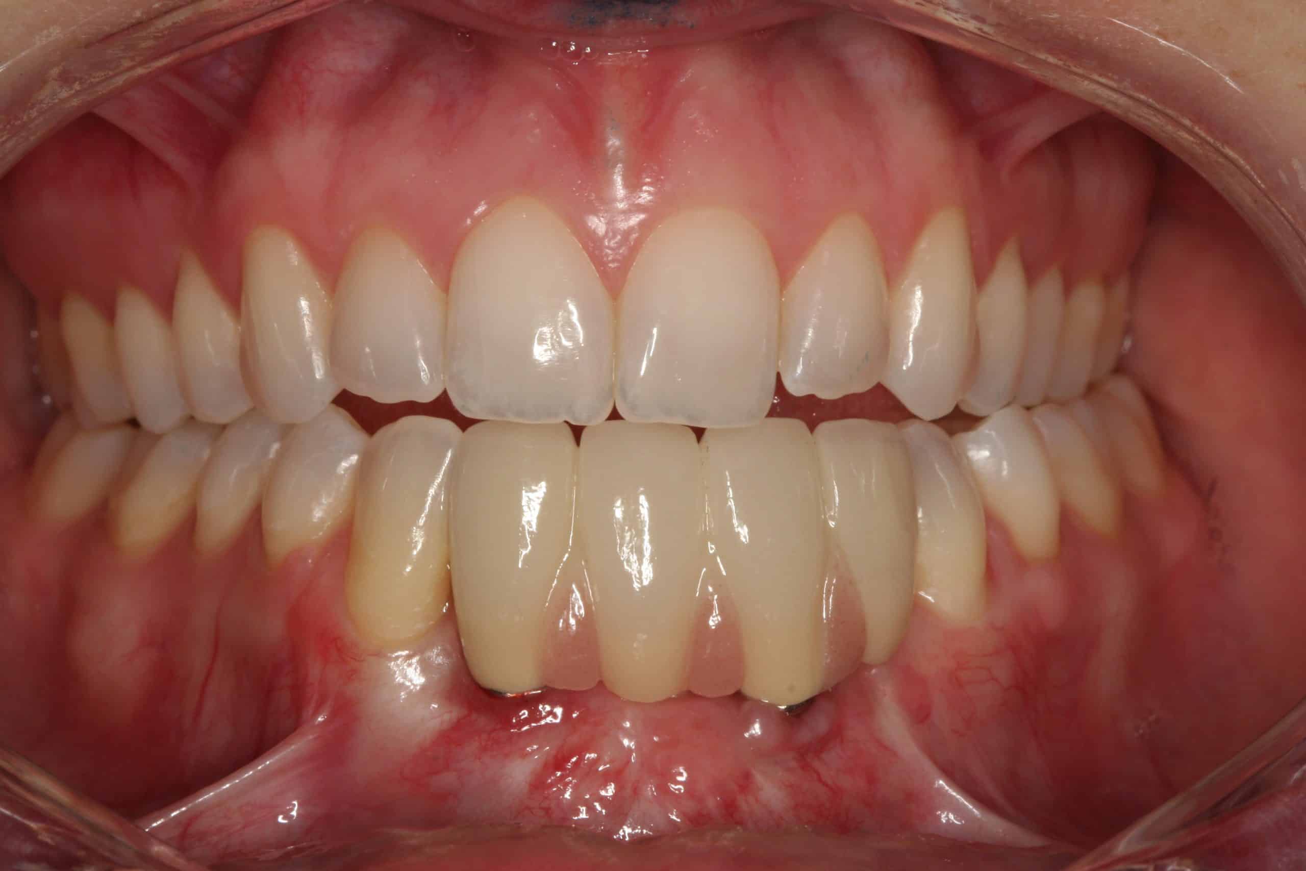 Case 4 - Advanced Dentistry & Dental Implant Center