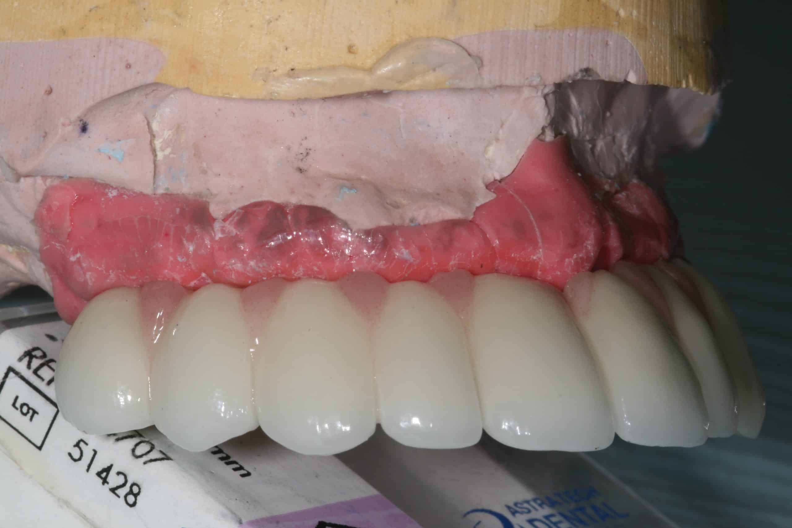 Case 2 Maxillary Full Arch Fixed Screwed (FP2) - Advanced Dentistry ...